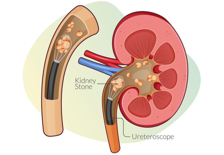 Complex & Staghorn Kidney Stones | Urologist | Ryan Hsi, MD ...